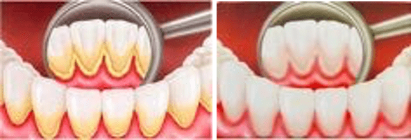 Profilaxia dental: o que é e como é feita - Redeplus Odontologia